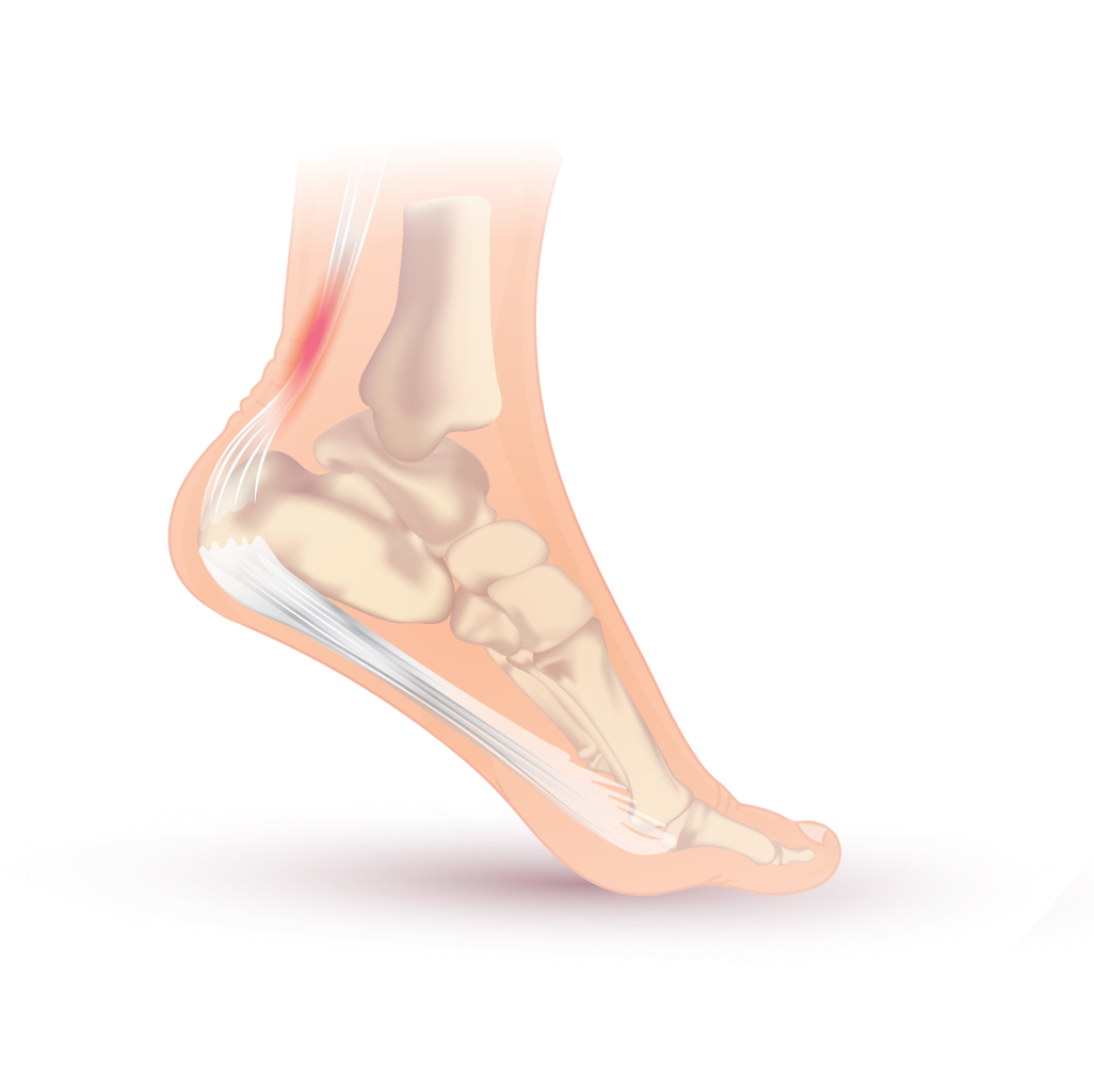 Achilles Tendinitis | Imperial Foot & Ankle Specialists, Inc.